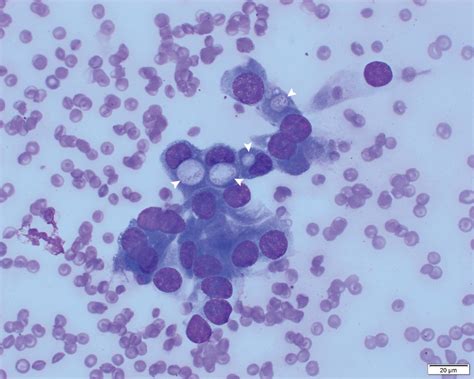 Transitional Cell Carcinoma Cytology