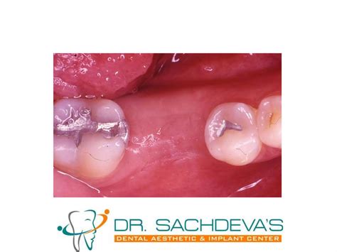 Socket Preservation Ridge Preservation Pptx Dental Health Diseases And Conditions