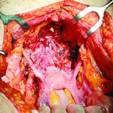 Final Configuration Of The Neobladder Download Scientific Diagram