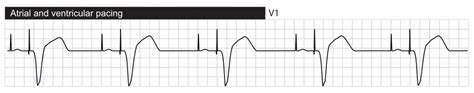 Interpretation Of Pacemaker Ecg The Cardiovascular