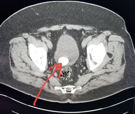 What Does Bladder Cancer Look Like On A Ct Scan Ct Scan