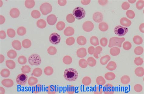 Basophilic Stippling