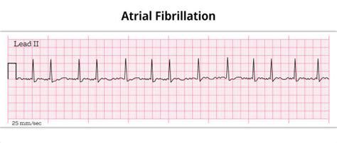 60 Ecg Atrial Fibrillation Stock Illustrations Royalty Free Vector