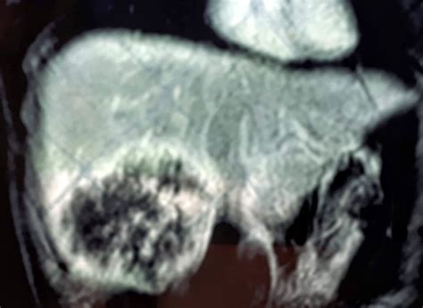 Open Laparoscopic Or Robotic Via To Treat A Giant Intra Hepatic