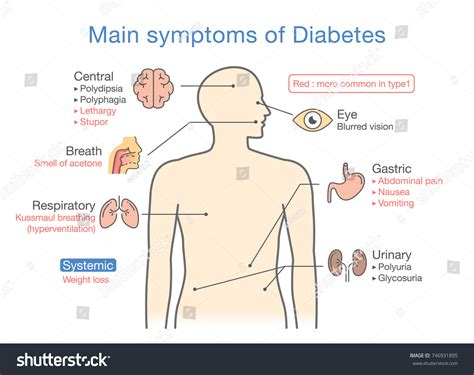 Main Symptoms Diabetes Illustration About Diagram Stock Vector Royalty