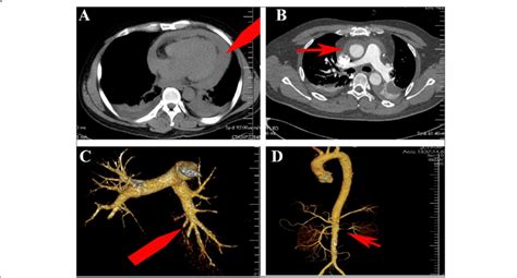 Cta Of Pulmonary Artery Thoracic Aorta And Abdominal Aorta A Download Scientific Diagram