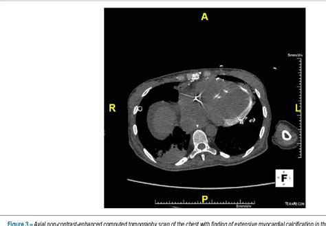 Figure 1 From Extensive Myocardial Calcification In A Heart Transplant Patient Semantic Scholar