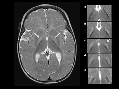 Acute Bilirubin Encephalopathy And Its Progression To Kernicterus Cur Rrn