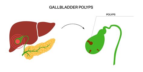 Gallbladder Polyp Ayurveda Treatment At Martha Holt Blog