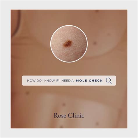 How Do I Know If I Need A Mole Check Rose Clinic Mole Screening