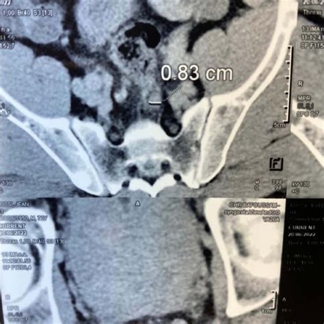 Metastatic Prostate Cancer With Lymph Node Extension Download