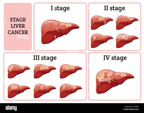 Cartoon Internal Human Organ Disease Concept With Four Stages Of Liver Cancer Vector