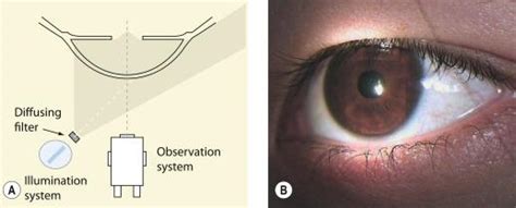 Anterior Eye Examination Clinical Tree