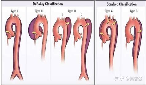 主动脉夹层动脉瘤 知乎