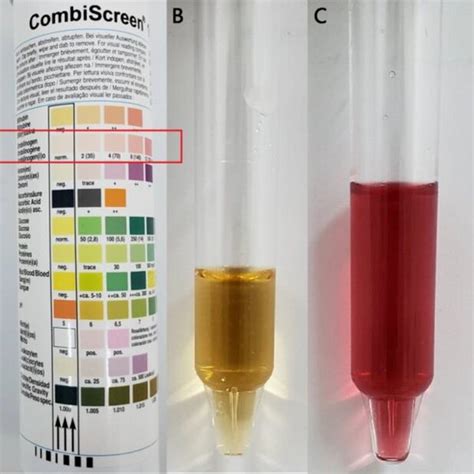 Elevated Levels Of Urinary Urobilinogen In Acute Hepatic Porphyria Download Scientific Diagram
