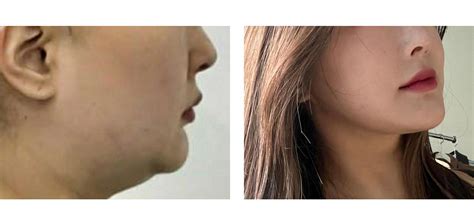 파워v얼굴지방흡입 이중턱 근육묶기 15개월차 후기 닥터정 리반의원 파워v얼굴지방흡입 이중턱 근육묶기 15개월차 후기 닥터정 리반의원