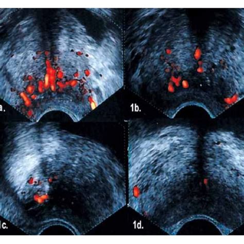 Dce Mri Of The Prostate With Coloured Parametric Maps Of The Prostate