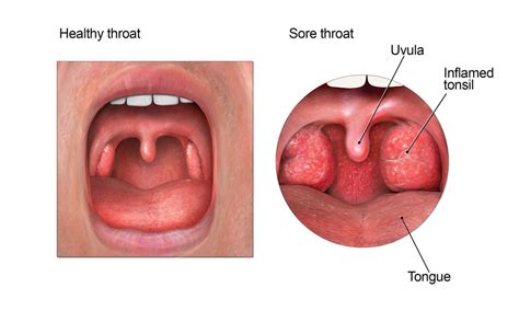 Sore Throat Causes And Treatment Pediatrics Northwest