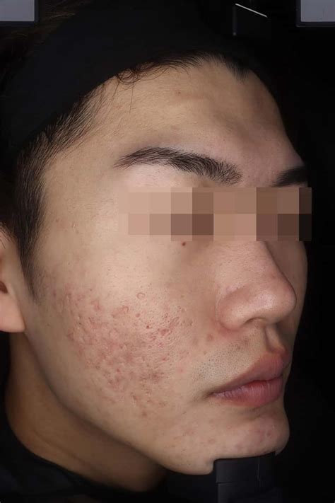 中野駅南口皮膚科のシミ取りレーザー治療 医療法人社団白和会 中野駅南口皮膚科