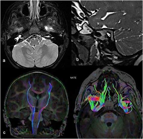 A Axial T2 Mri Showing The Cochleo Vestibular Anomalies Ipi B
