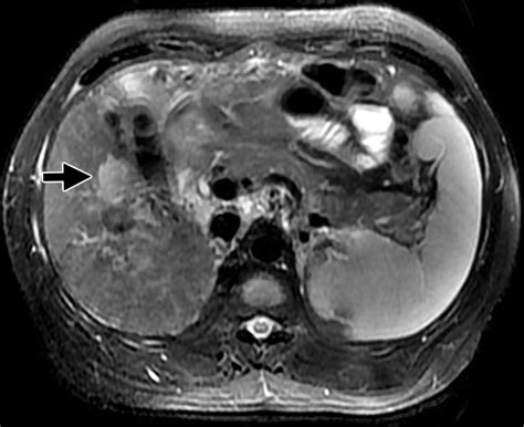 small intrahepatic cholangiocarcinoma and hepatocellular carcinoma in cirrhotic livers may share