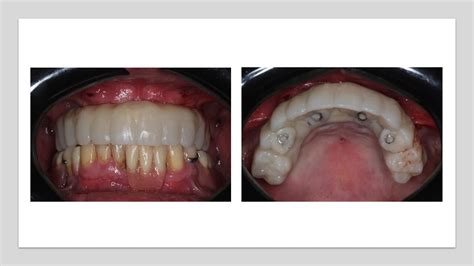 Full Arch Guided Restoration Using Stackable Guide Protocols