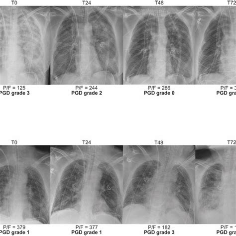 Grading Of Primary Graft Dysfunction Pgd After Lung Transplantation