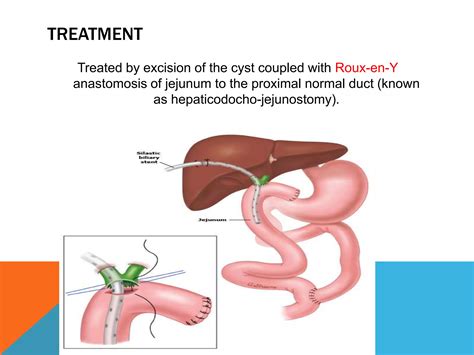 Choledochal Cystpptx