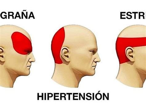 Ejercicios Para Dolor De Cabeza Noticias Centro De Fisioterapia Y Osteopatía Veraluz En