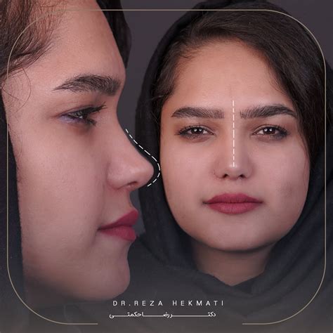 ‎دکتر رضا حکمتی‎ ‎۲ ماه بعد از عمل بینی با پوست ضخیم و نوک افتاده و