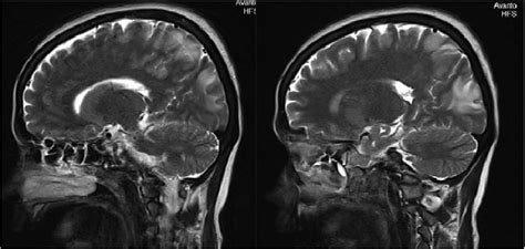 Sagittal View Of Mri Brain Showing Bilateral Occipital Parietal Download Scientific Diagram