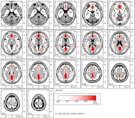Figure 1 From Theta Eeg Source Localization Using Loreta In Partial Epilepsy Patients With And
