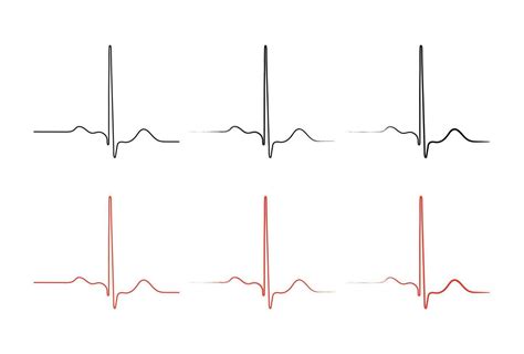 Ventricular Repolarization Cardiac Cycle Ecg Of Heart In Normal Sinus Rhythm Qt Interval Of