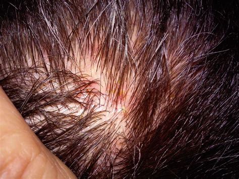 Scalp Folliculitis Pictures Pictures Photos Vrogue Co