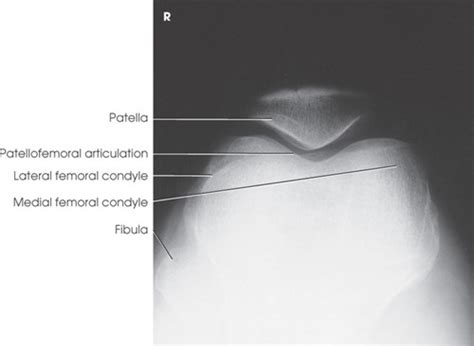 Patella And Femur Projections Flashcards Quizlet