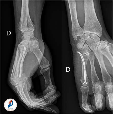 Fracture Du 5ème Métacarpien à Bordeaux Mérignac