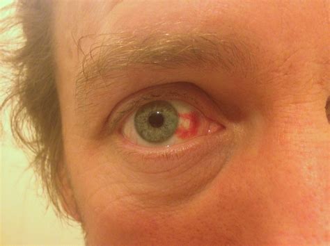 Sub Conjunctival Haemorrhage Clearing Dont Be A Salmon