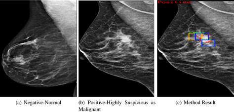 Figure 1 From Mammogram Classification And Abnormality Detection From Nonlocal Labels Using Deep