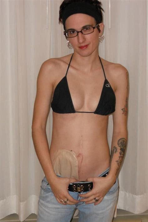 17 Best Images About Ostomy On Pinterest Camps A Website And Bags