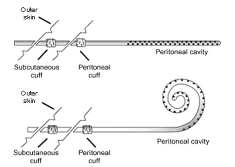 Milestones On The Development Of Peritoneal Dialysis Timeline