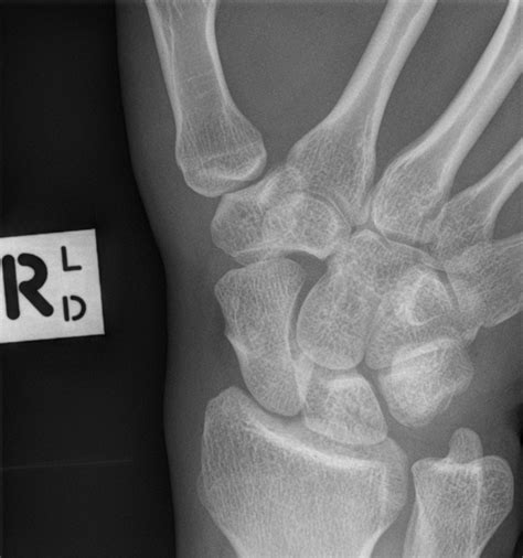 Scaphoid X Ray Angle