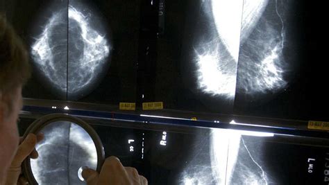 U S Requires New Info On Breast Density With All Mammograms