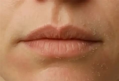 How To Get Rid Of Dry Skin Around The Mouth Health Advisor