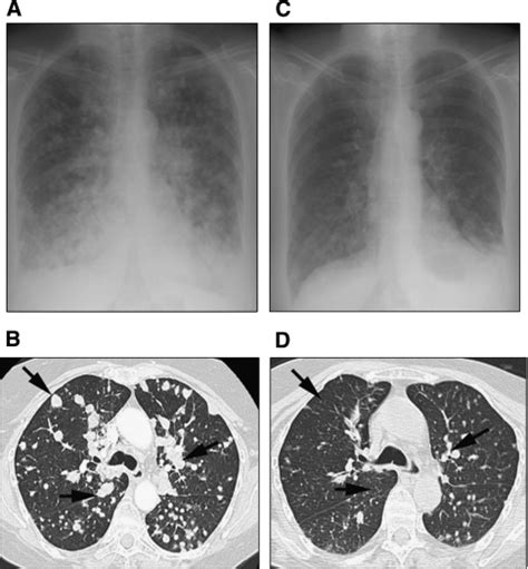Chest X Ray And Chest CT Images At Baseline A B And Then At 1 Month Download Scientific