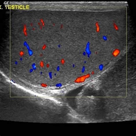 Wedge Shaped Hypoechoic Lesion In The Anterior Aspect Of The Right