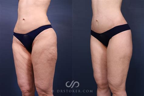 Bikini Body Lift ™ Before And After Pictures Case 2634 Los Angeles