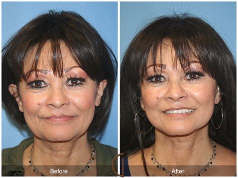 Bad Face Lifts Before After Bad Face Lifts Before After