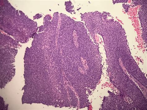 Cervical Biopsy Showing Squamous Cell Cancer With Positive P16 Staining