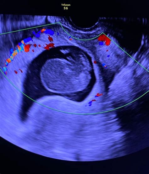 Chorionic Bump Is A Rare Condition Defined As A Bulge Or Protrusion From The Choriodecidual