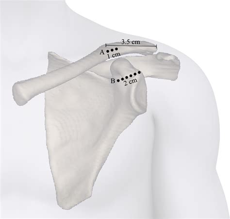 The Dotted Lines Represent Surgical Incisions A 1 Cm Transverse Download Scientific Diagram